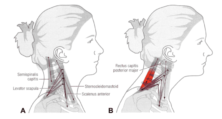 Top Tips to Avoid Neck Pain | Perth Sports Physio